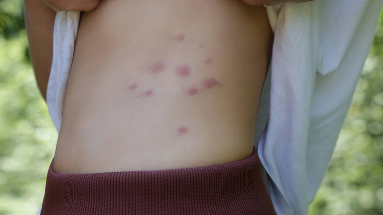 ¿Cómo identificar una picadura de chinche y cómo tratarla?